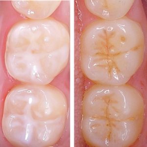 General Dentistry Brisbane | Preventative Dentistry | General Dental Care