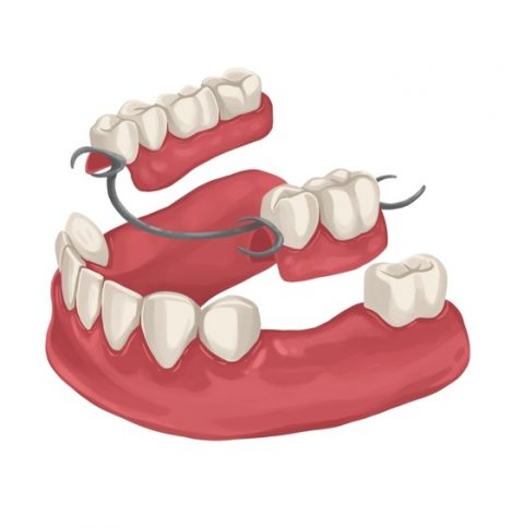 Regain Your Smile with Partial Dentures in Brighton & Brisbane – Beyond ...