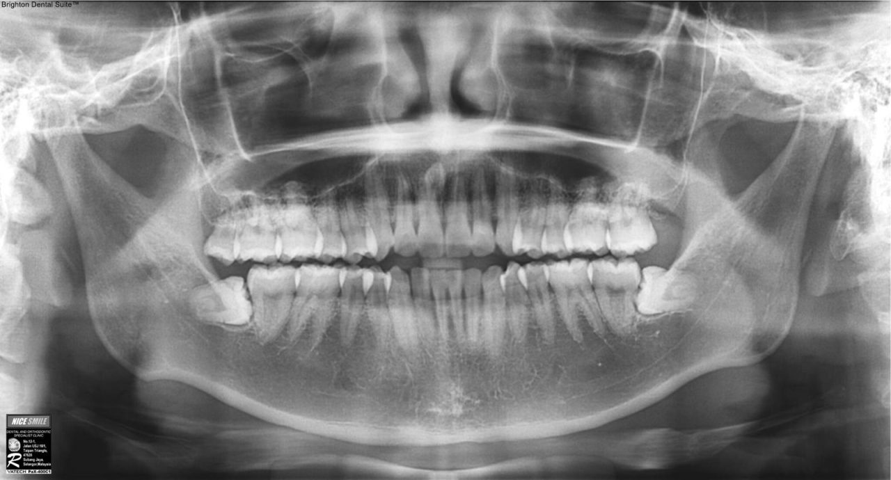 Wisdom Teeth Pain | Wisdom Tooth Symptoms | Impacted Molars & Extraction