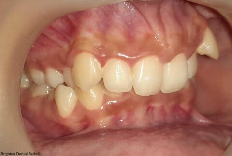 Understanding Overcrowded Teeth: Causes, Treatments, and Solutions