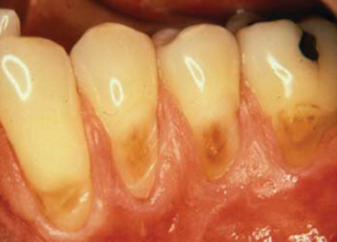 Tooth Abrasion: Causes, Symptoms, and Treatment Options