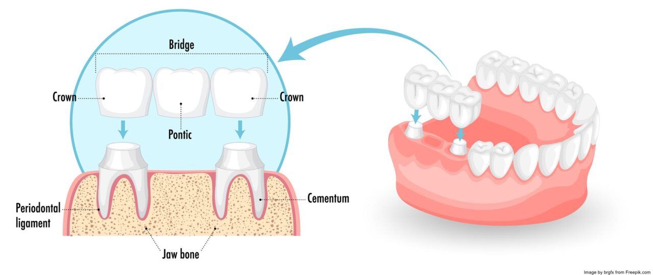 Dental Bridges Brisbane | Tooth Bridges | Cosmetic Dental Bridges